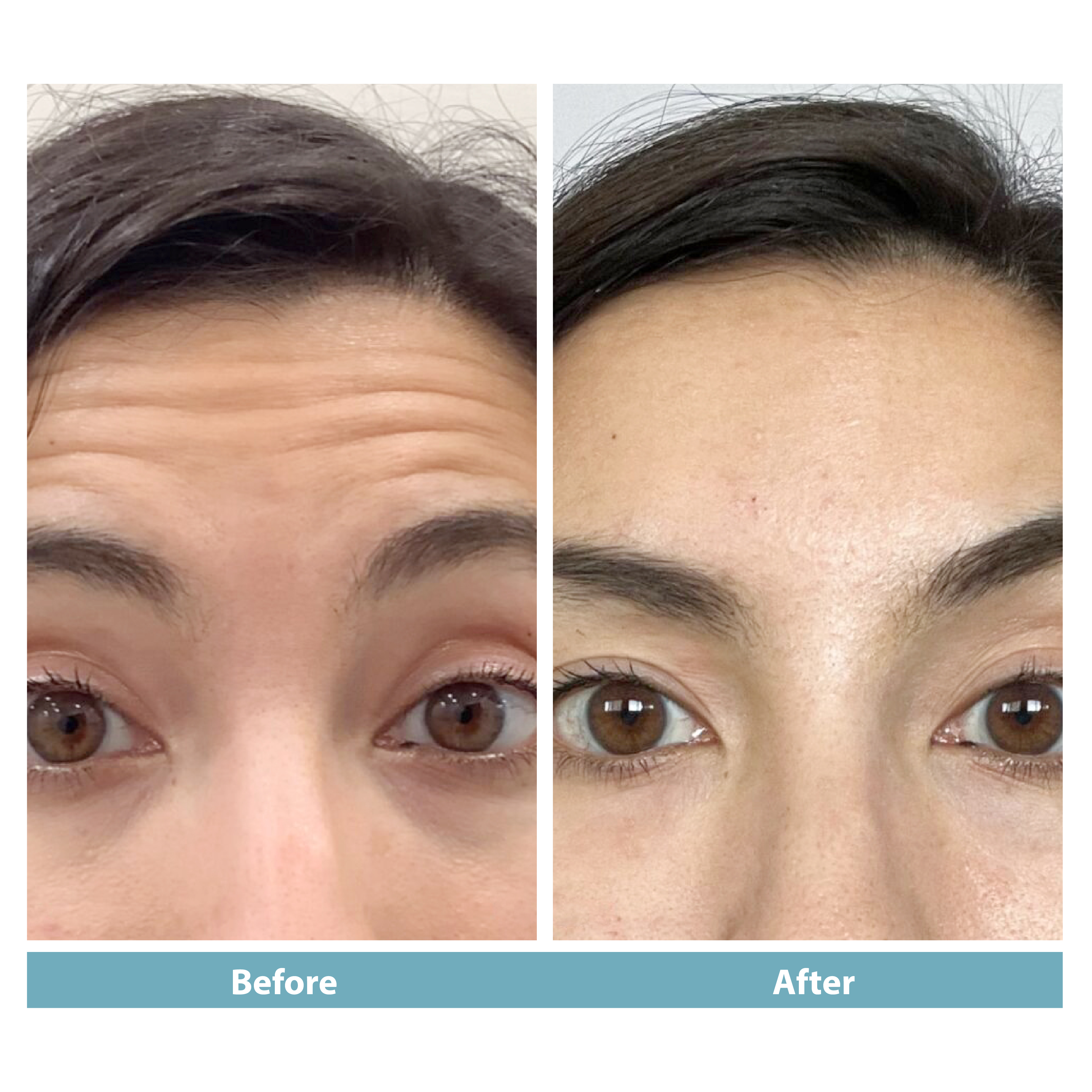 Botox for wrinkle reduction