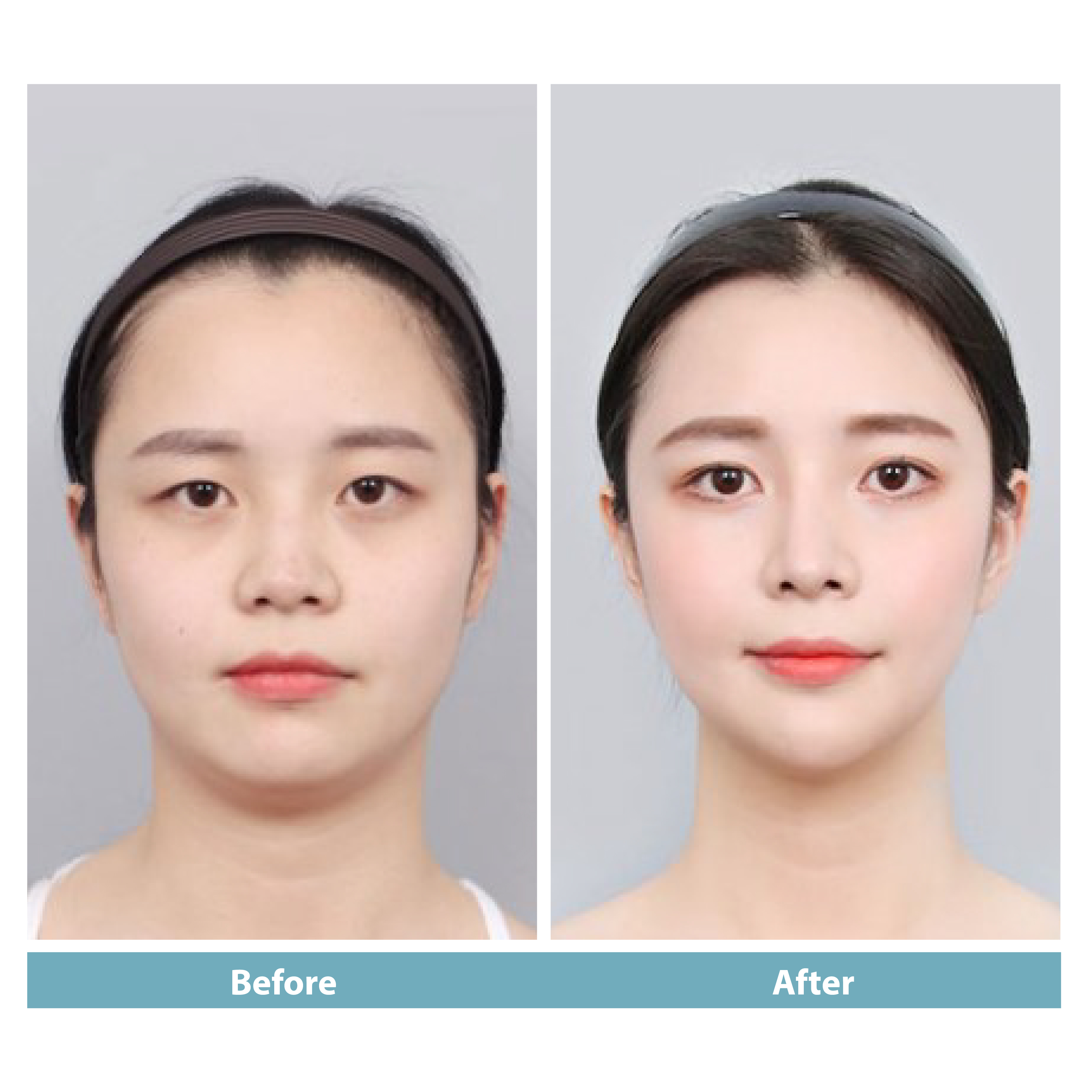Tiêm Tightening Botox tạo mặt V-line Muse Clinic