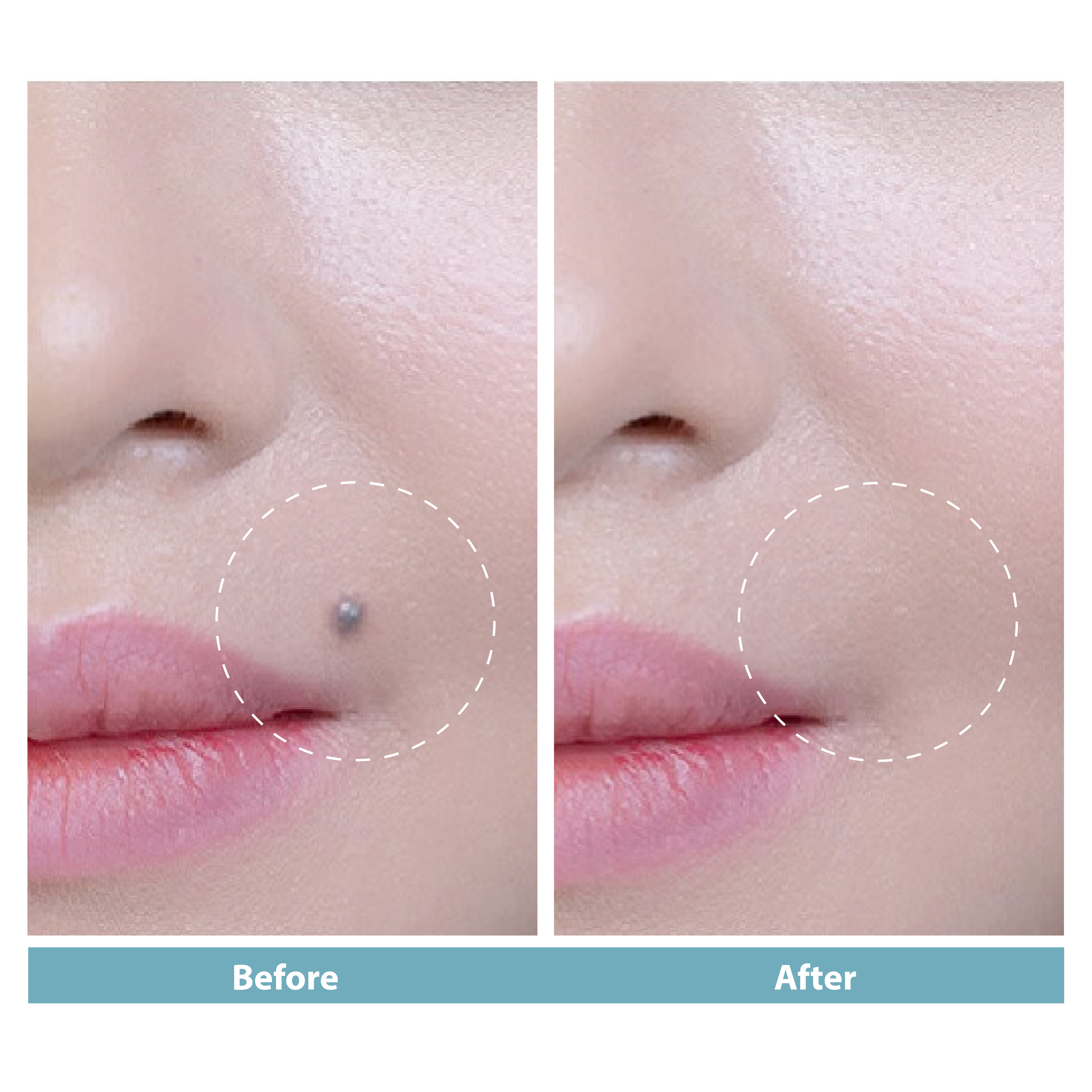 Laser small/large mole removal (1 dot)