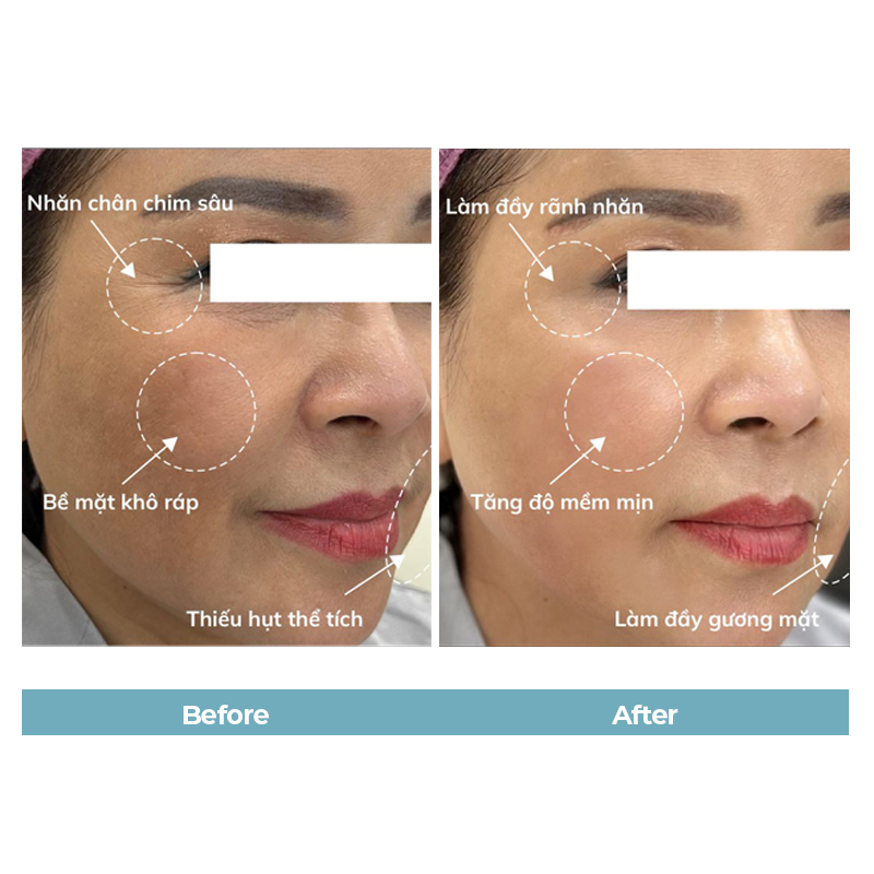 Karisma rejuvenate the skin and visibly reduce deep wrinkles.
